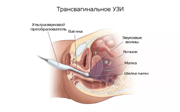 Transvaginální ultrazvuk