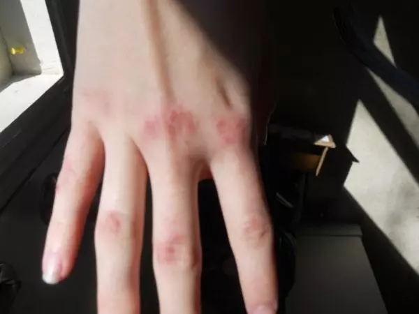 हात च्या त्वचेच्या frostbite
