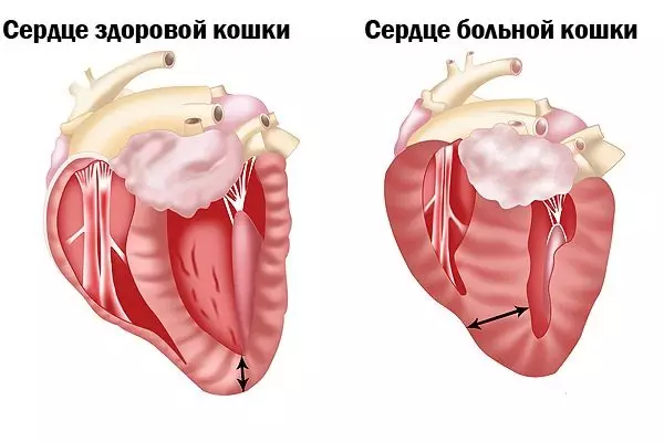 Hipertrofiese kardiomyopatie
