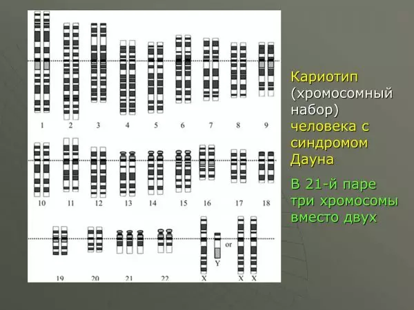 Man karyotype with Down syndrome