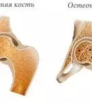 Normaler Knochen und Osteoporose