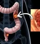 Cancro intestinal.