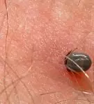蜱咬3。