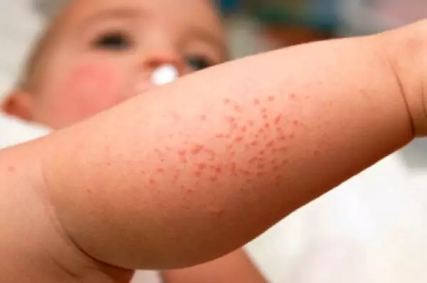 Manifestacio de alergio sur la haŭtaj kruroj de infano